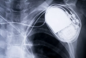 Pacemaker - Specialist Cardiology